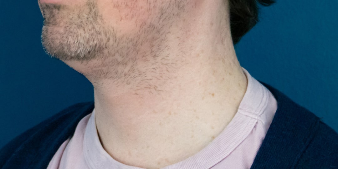 Face Procedures Archives - Chicago Medical Spa | Skin Rejuvenation ...