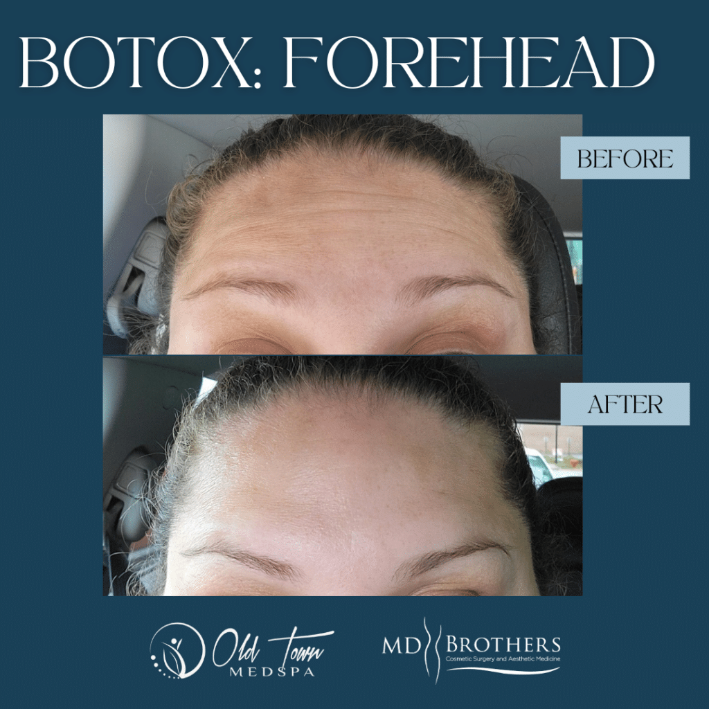Botox Chicago - Forehead & Wrinkle Treatment in Lincoln Park, IL